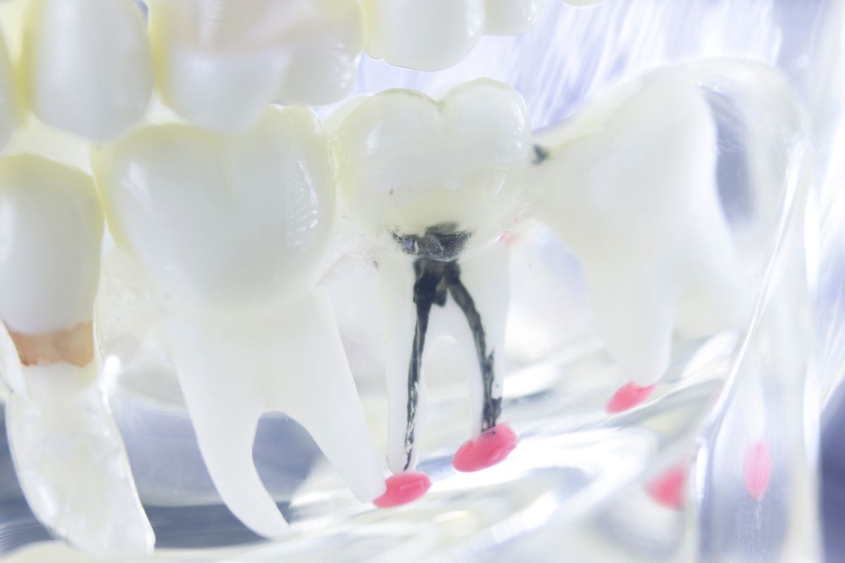 What to Expect During a Root Canal Therapy | Rockville Centre for Dentistry